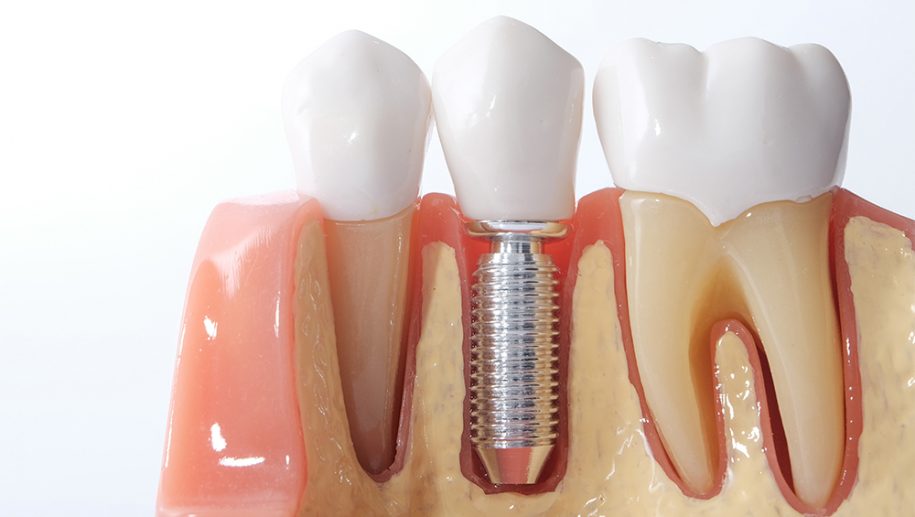 Implantati - Dental Sandev